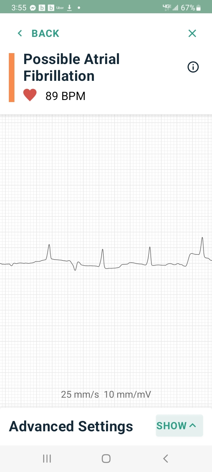 Treating A-fib with Tikosyn (Dofetilide)
