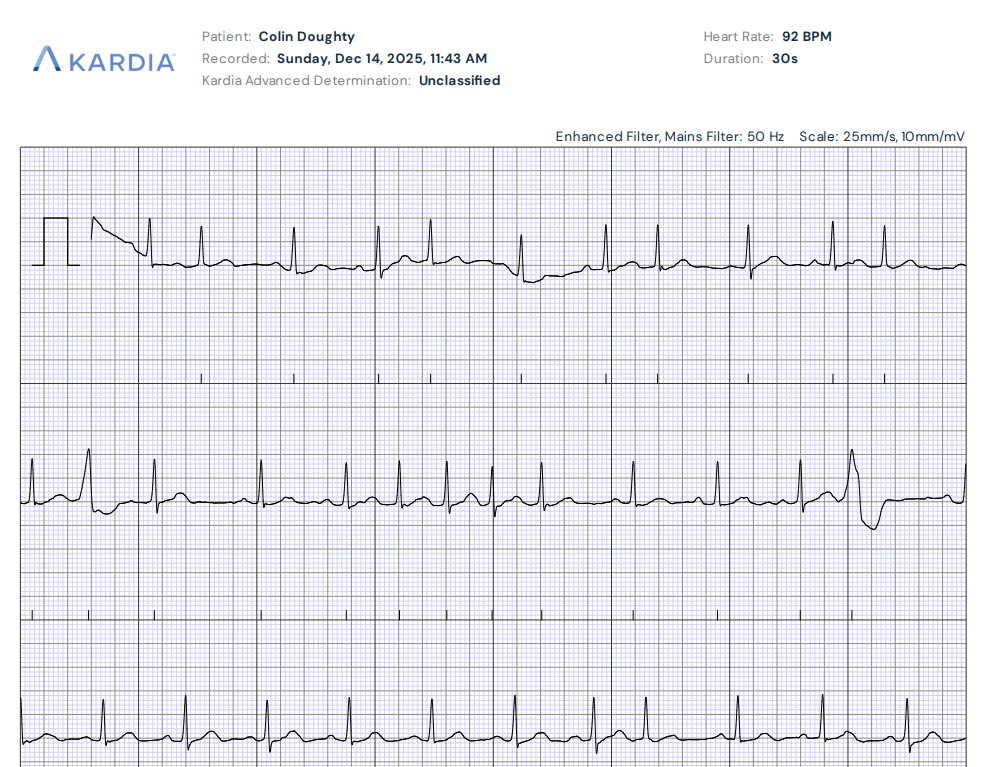 It's like Afib but with normal P wave